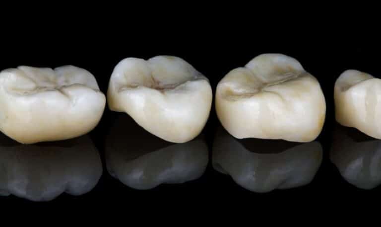 Is It Possible To Whiten Dental Crowns?
