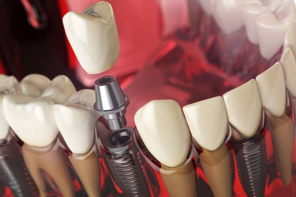How Dental Implants Can Assist in Managing TMD